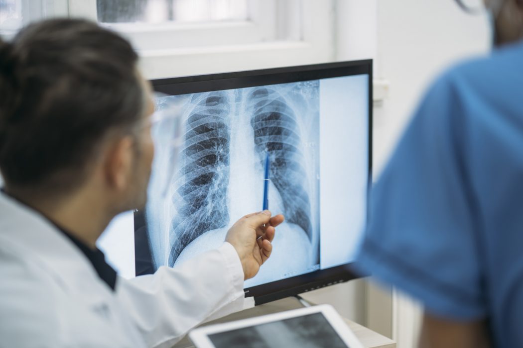 Brock-led research shows effectiveness of lung cancer prediction model ...